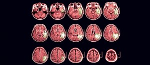 O que é atrofia cerebral? | Clínica Cauchioli